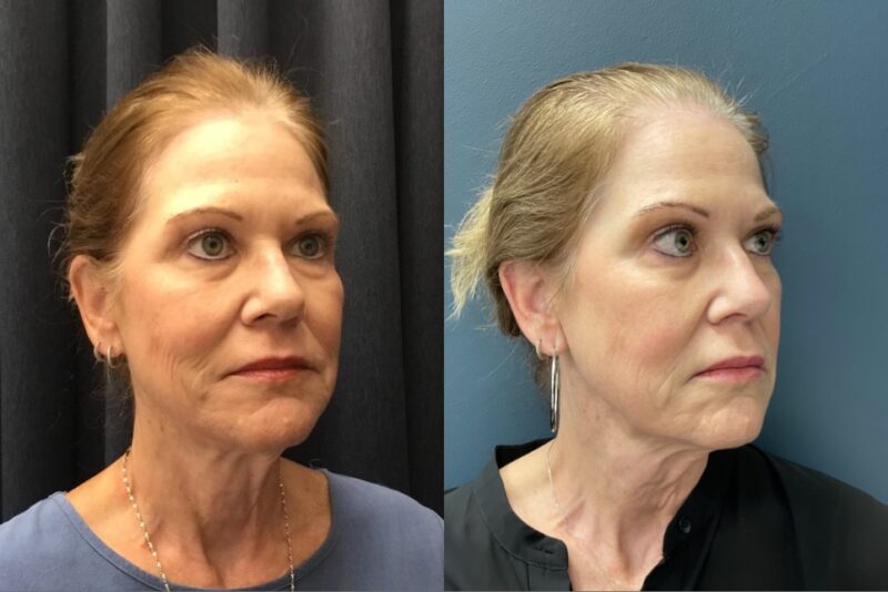 Brow Lift Fort Worth - Forehead Lift - Kirby Plastic Surgery